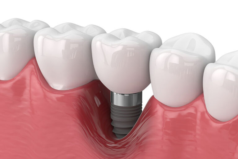 LAPIP® Laser Peri-Implantitis Treatment | Max Dental Group | Hicksville, NY